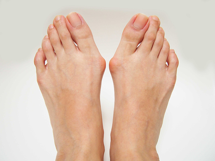 What is a Bunion & How Do You Treat Them? - Profoot